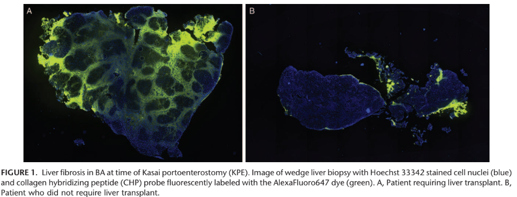 CHPs’ can Help Predict Liver Survival in Biliary Atresia – 3Helix Inc