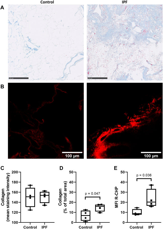 Uncovering Fibrosis: Superior Sensitivity of CHPs in Targeting IPF ...